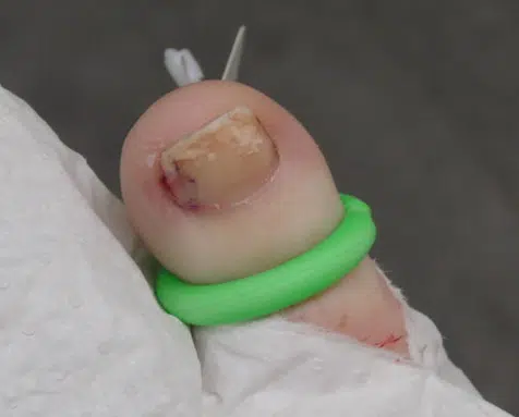 Nail Surgery Phenolisation - Foot Focus Podiatry